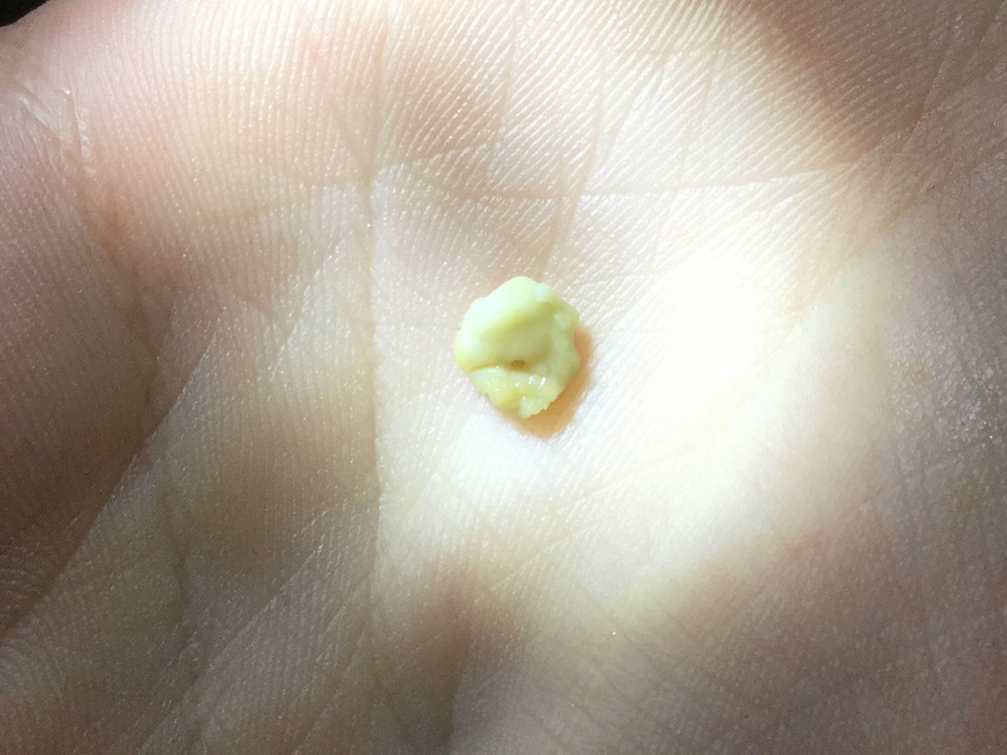 Gehemeltegaatjes | Tandarts.nl Forum